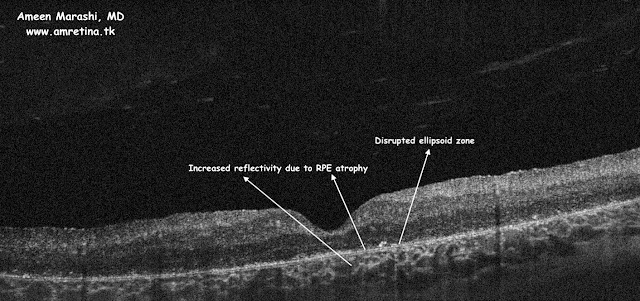 Cone-Rod Dystrophy an example of RPE atrophy due to cone-rod dystrophy