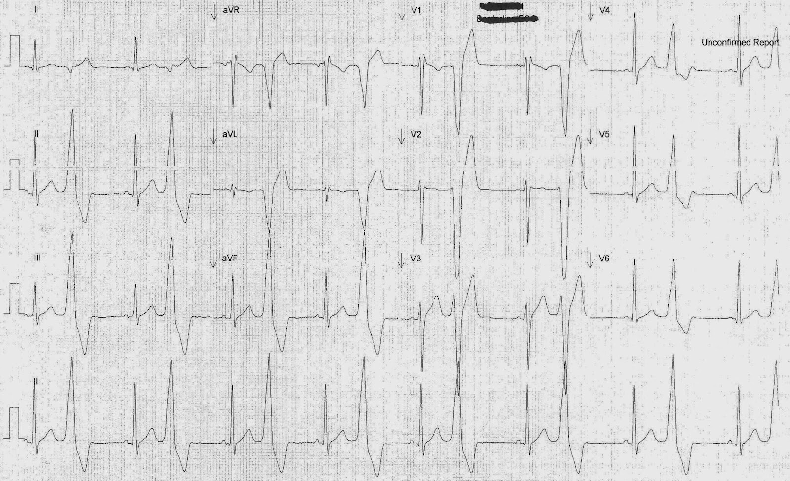 ECG of the Week: ECG of the Week - 16th April 2012 - Interpretation