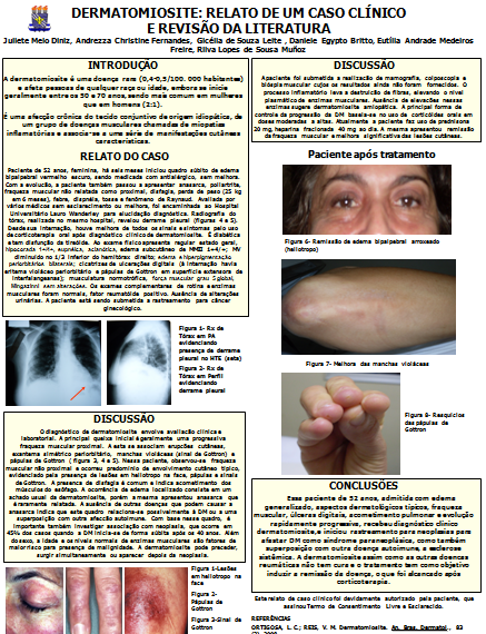 SEMIOBLOG HUMANITAS: Dermatomiosite: Relato de um Caso