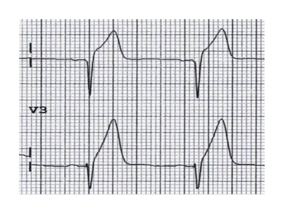 All that you need to know to diagnose MI / ACS