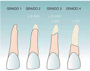 ORTODONCIA OJANGUREN: Reabsorciones radiculares Parte II