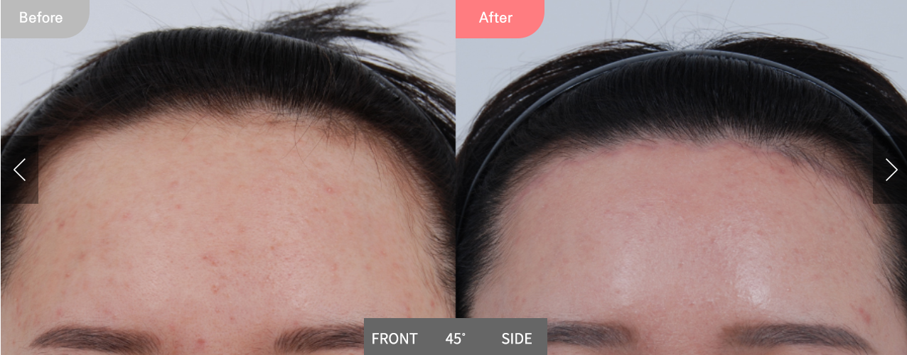 [ATOP Plastic Surgery Korea] Forehead Reduction (Forehead shortening ...