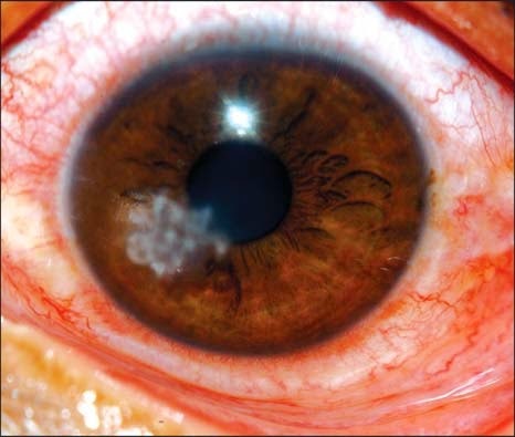 Clinical Presentation of Fungal Keratitis | Tuyenlab