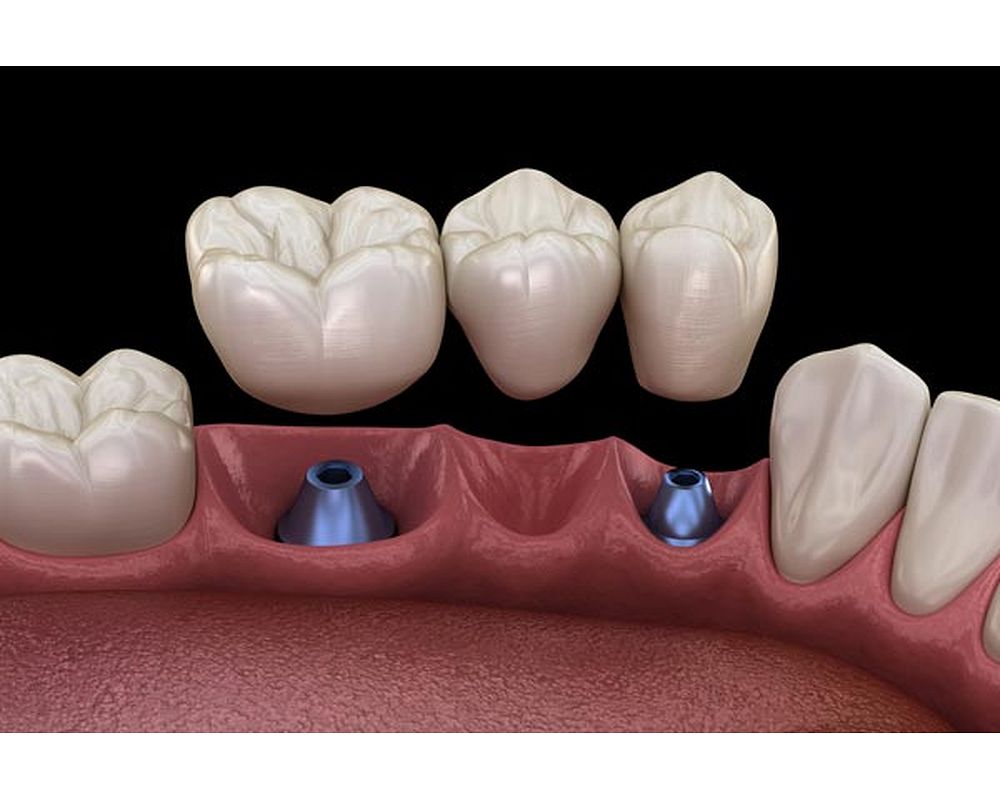 What's the Difference Between Dental Implants and Bridges? - OdontoVida