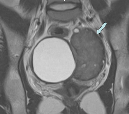 mricases: Ovarian Torsion