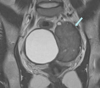 mricases: Ovarian Torsion