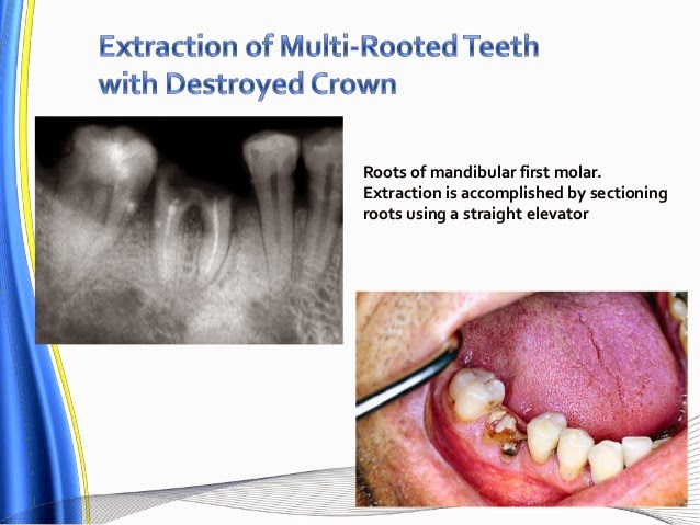 ODONTOS ACADEMY FOR CLINICAL DENTAL STUDIES: How to Extract a TOOTH ...