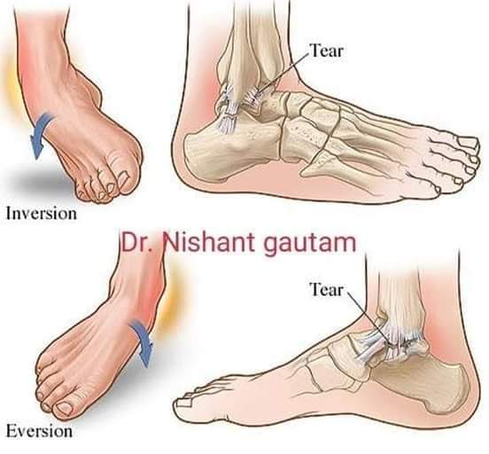 Pijat Urut Kelapa Gading: Kesleo Engkel Kaki