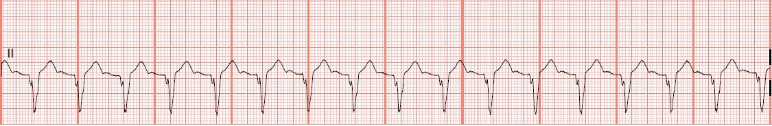 EKG Rhythm Strips 66