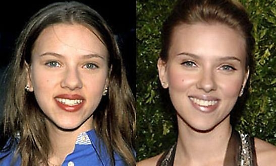Kate Beckinsale Plastic Surgery Before And After: Kate Beckinsale ...