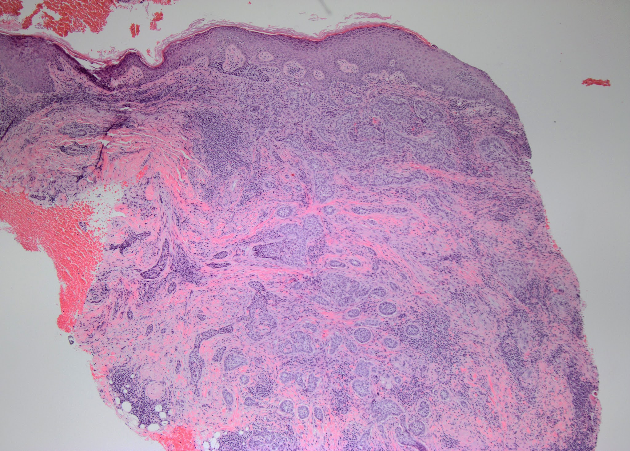 VIRTUAL GRAND ROUNDS IN DERMATOLOGY 2.0: 2021