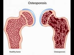 Physiotherapy and Anatomy: Greater trochanteric pain syndrome (GTPS)