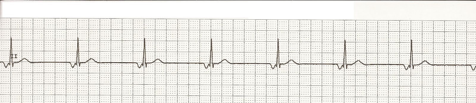 Float Nurse: EKG Rhythm Strips 14: Junctional Rhythms