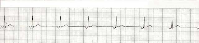 EKG Rhythm Strips 14: Junctional Rhythms