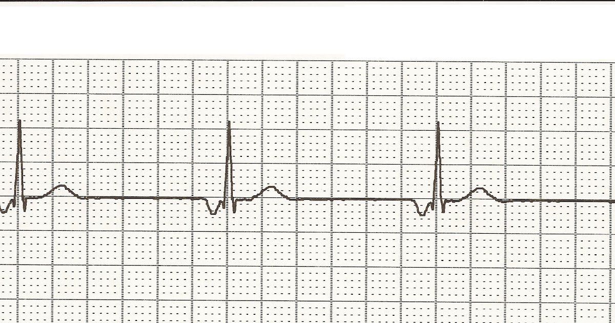Float Nurse: EKG Rhythm Strips 14: Junctional Rhythms