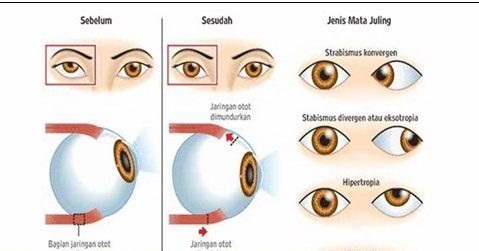Selamat Datang Di Klinik Jerry: 84. Penyakit Mata Jereng / Juling.