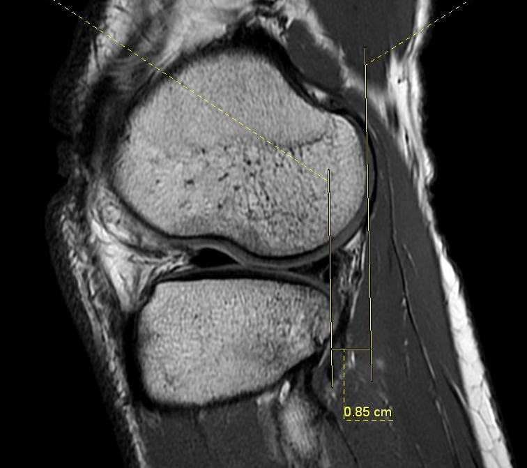 Signs of ACL tear on MRI- Resident's Corner - Sumer's Radiology Blog