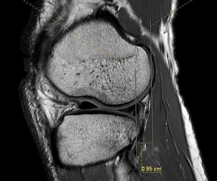 Signs of ACL tear on MRI- Resident's Corner - Sumer's Radiology Blog