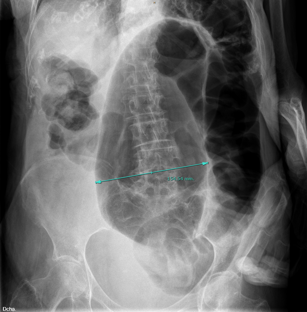 El Blog de Isa y Juan: Vólvulo de sigma