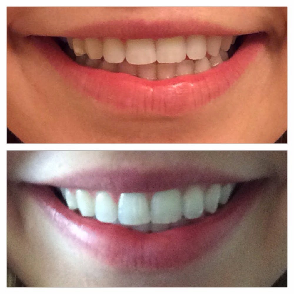 the girl and the makeup: Diary of Whiter Teeth- Colgate Optic White # ...