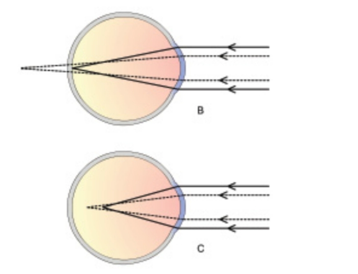 Type of astigmatism and its treatment