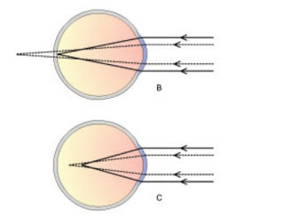 Type of astigmatism and its treatment
