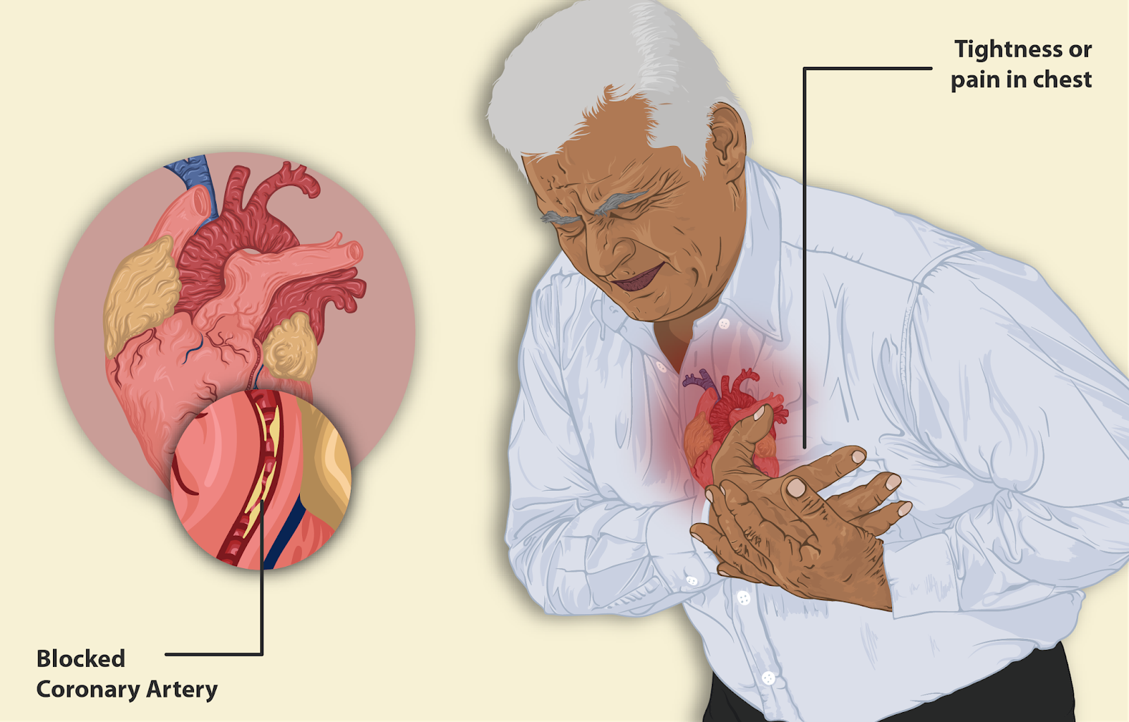 Causes,Symptoms and Precautions of Heart Attack