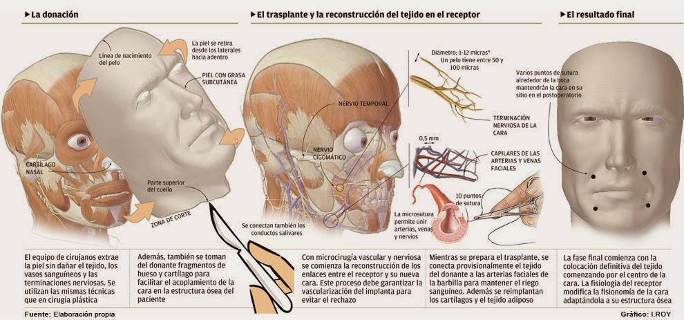Medicina: Culmina el primer trasplante de cara en España tras 15 horas de operación