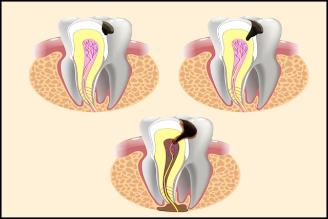 [Questão #24] Pulpite Aguda Reversível e Pulpite Aguda Irreversível ...