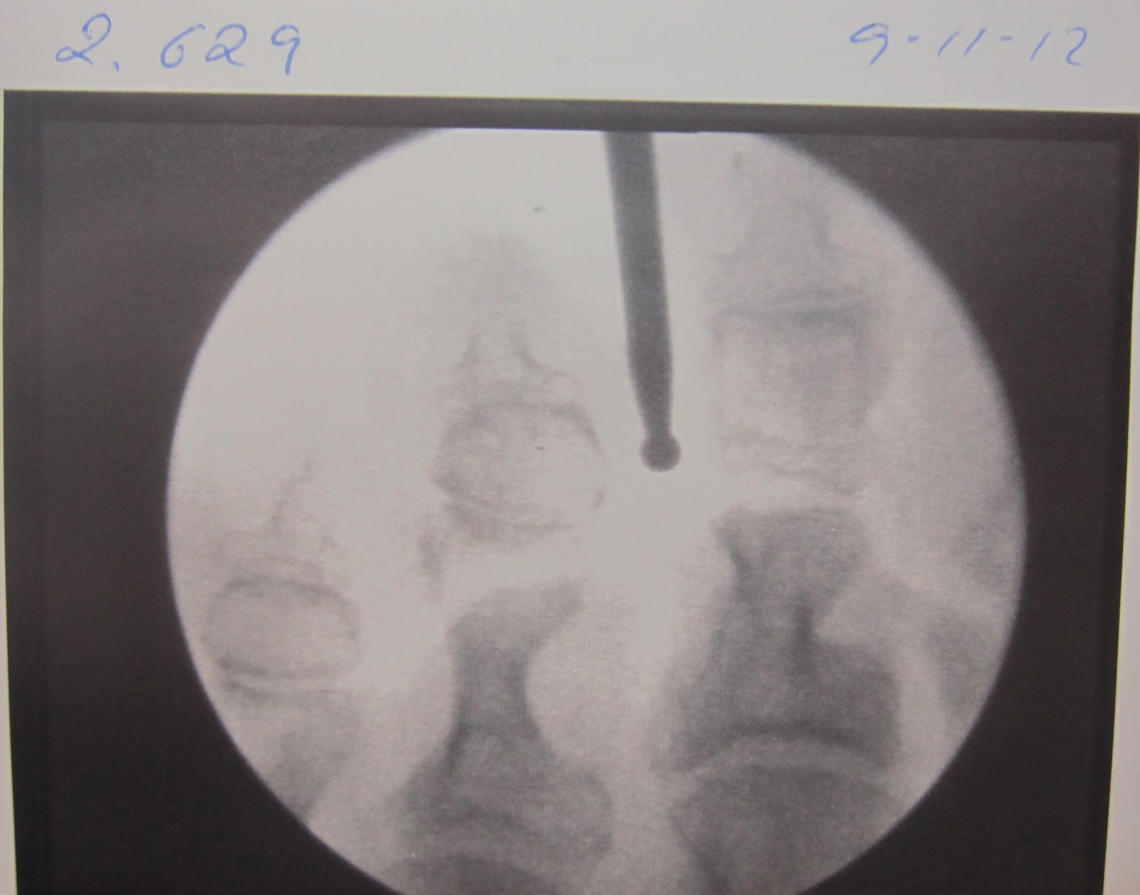 Podo Basas al Día: Operación dedos en martillo y helomas interdigitales.