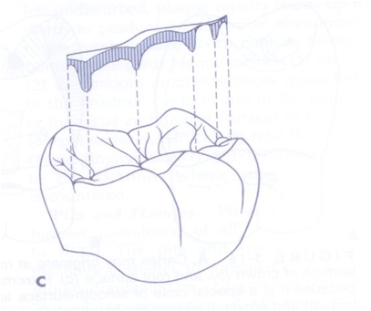SMILE CARE: CLASSIFICATION OF DENTAL CARIES