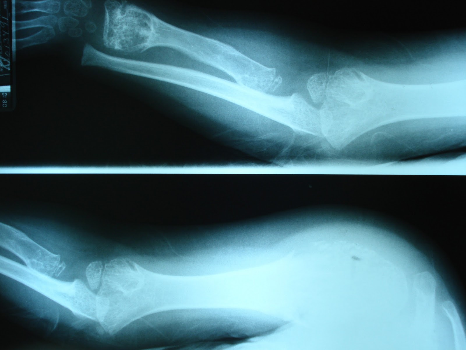 Ortopedia_Oncologica_Mexico: Encondromatosis múltiple, de la serie: Un ...