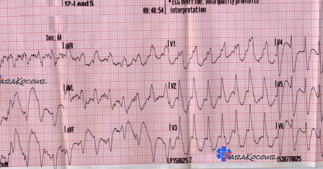 ParaKocour: EKG křivka #71