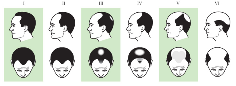 New England Associates®: Understanding Pattern Baldness
