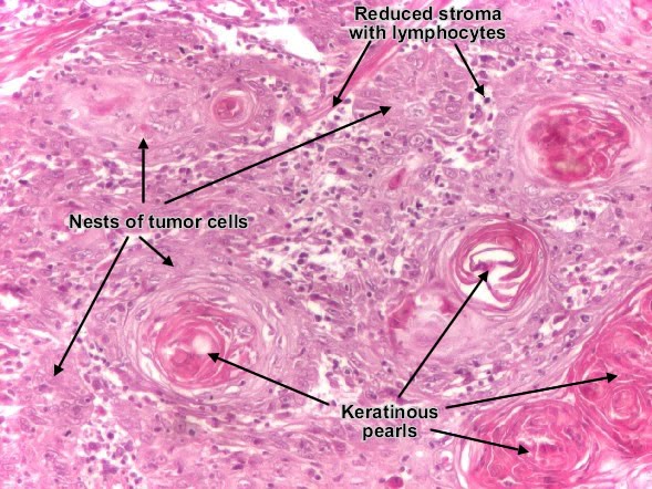Histology and explanation of Squamous cell carcinoma (skin) ~ MdBlogger