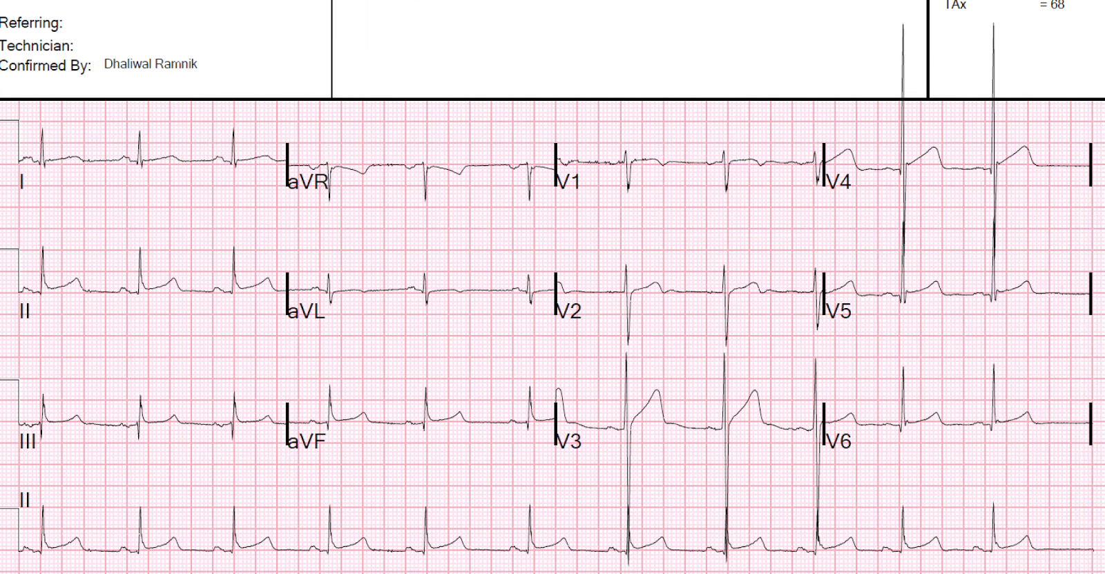 Dr. Smith's ECG Blog: 2 Cases of Resolved Chest Pain with Dynamic ...