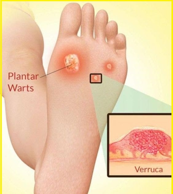 How to Treat Plantar Warts at Home Naturally - wellness days