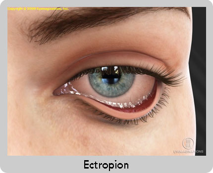 Ectropion; ectropions