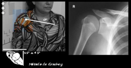 Ombro- Método de Grashey