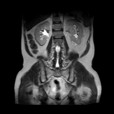 Renal Sinus Tumor-MR urography - Sumer's Radiology Blog