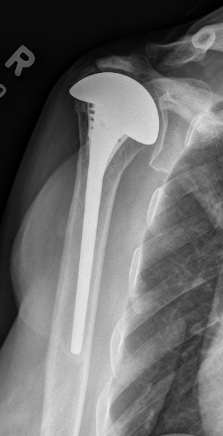 Shoulder Arthritis/Joint Replacement Rotator cuff tears: CTA ...