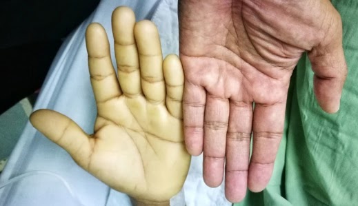 10 Signs and Symptoms of Iron Deficiency - HEALTH CARE