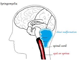 Amna Pharmacy: SYRINGOMYELIA: Causes, Diagnosis and Treatment