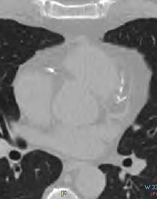 Chest Section: Scan Images: Three Grades of Calcium Plaque Burden