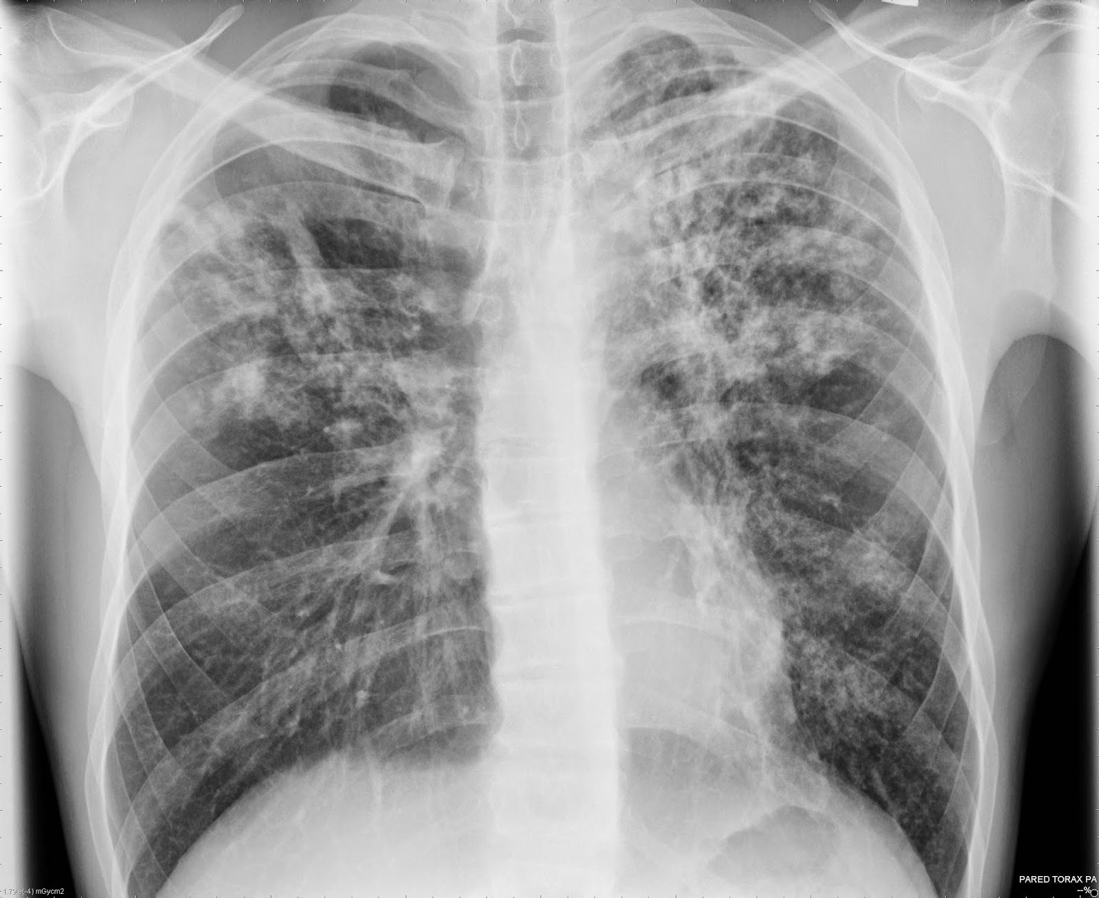 ENFERMEDADES RESPIRATORIAS | TUBERCULOSIS - Es Salud