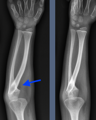 Forearm Synostosis- Facts and My Approach to Treatment | Congenital ...