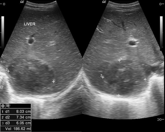 MEDICAL ULTRASOUND/ HEPATIC ABSCESS