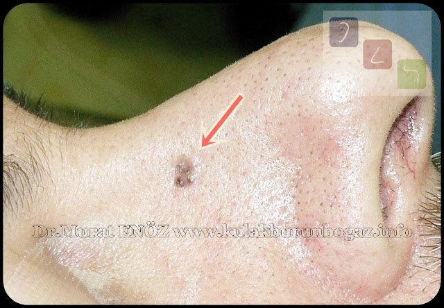 Nodular Type Basal Cell Carcinoma of the Nose