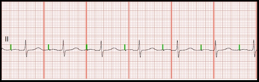 Practice EKG Rhythm Strips 116