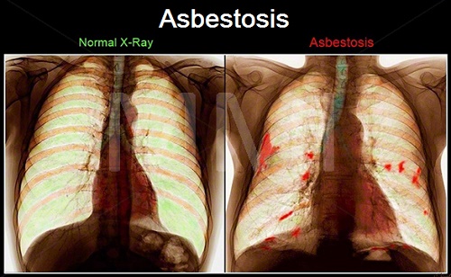 Asbestosis | Mesohealth